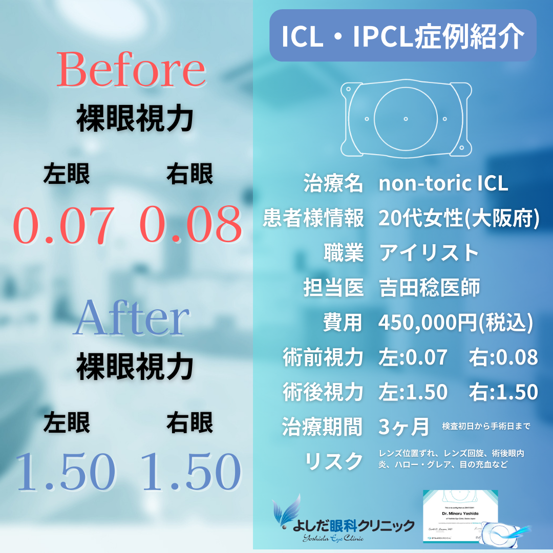 大阪でICL手術なら大阪市港区のよしだ眼科クリニック｜ICL認定医が執刀